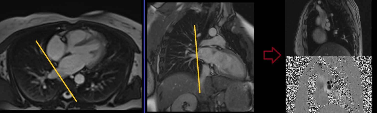 Cardiac MRI Flow Quantification Protocols, Planning and Techniques