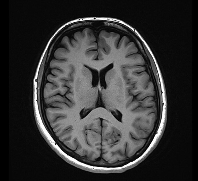 T1 MRI | MRI T1 weighted sequences