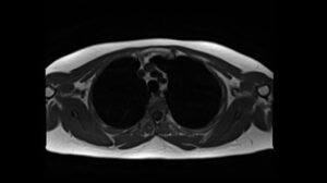 T1 MRI | MRI T1 weighted sequences