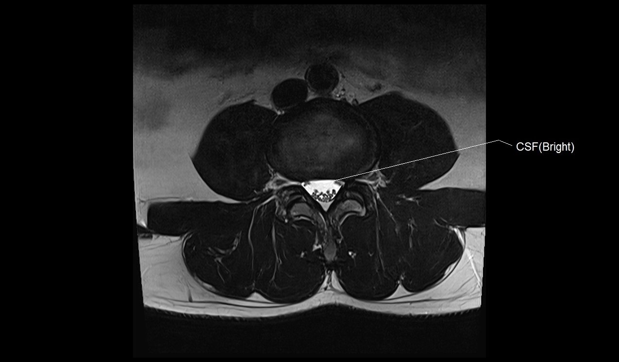 T1 vs T2 MRI | T1and T2 MRI image comparison