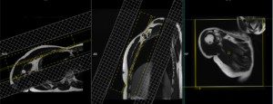 MRI Pectoralis Muscle Protocol ,Planning and Positioning