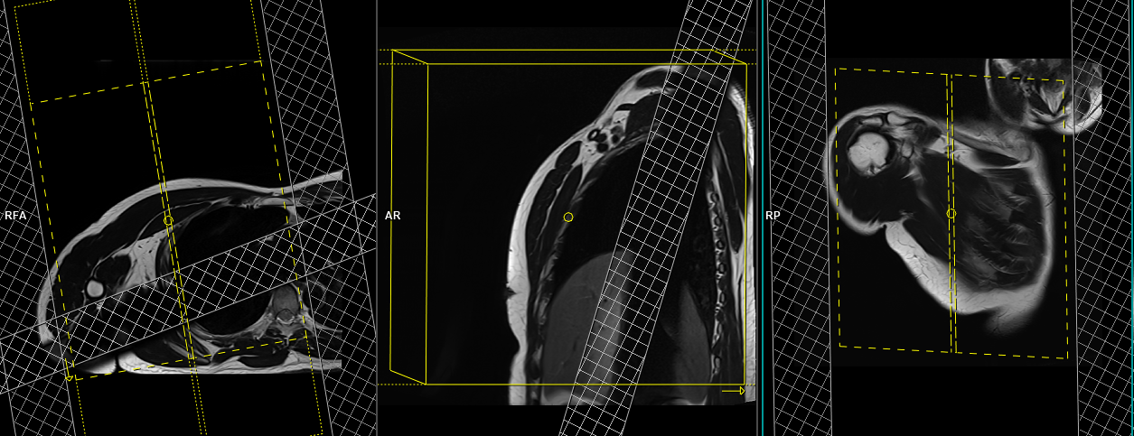 MRI Pectoralis Muscle Protocol ,Planning and Positioning