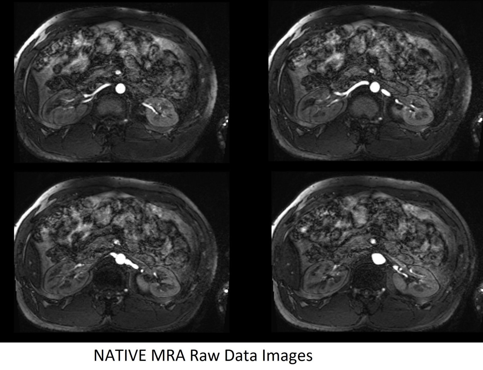 NATIVE MRI | Native Space MRI | NATIVE MRA Protocol and Planning