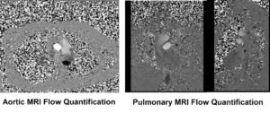 Cardiac MRI Flow Quantification Protocols, Planning and Techniques