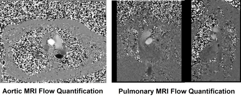 Cardiac MRI Flow Quantification Protocols, Planning and Techniques
