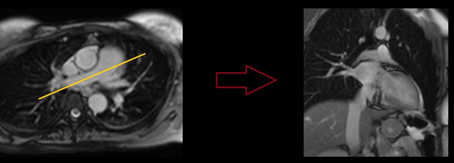 Cardiac MRI Flow Quantification Protocols, Planning and Techniques
