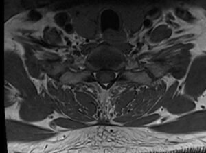 T1 MRI | MRI T1 weighted sequences
