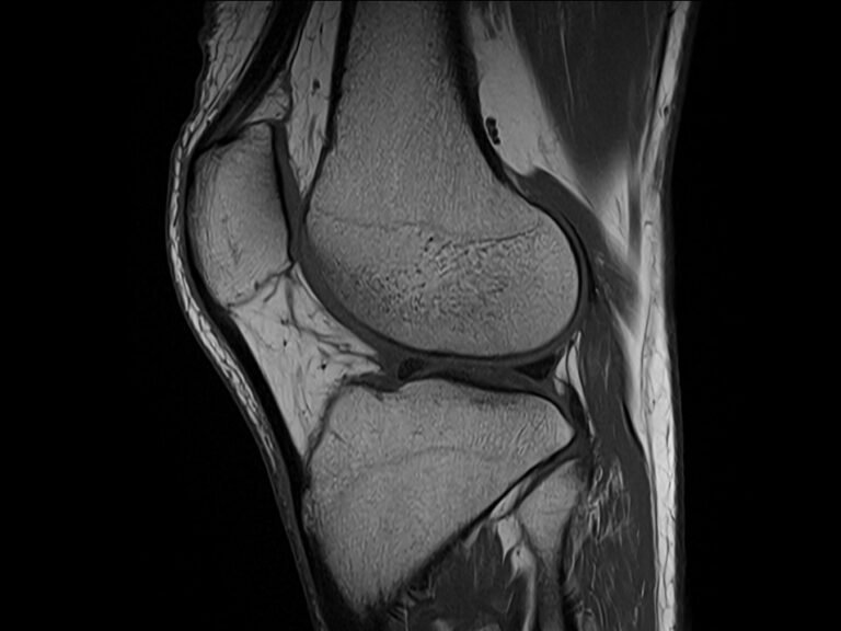 T1 MRI | MRI T1 weighted sequences