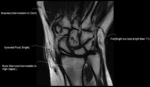 T1 vs T2 MRI | T1and T2 MRI image comparison