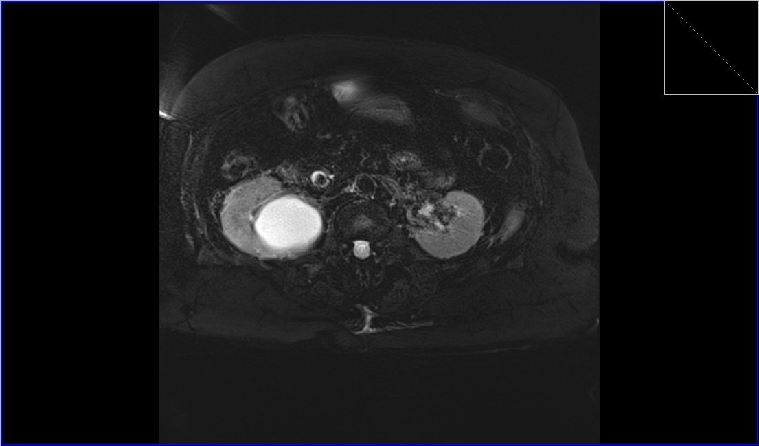Choledocholithiasis MRI - mrimaster Choledocholithiasis MRI