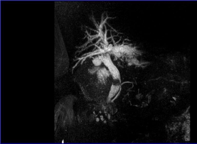 Choledocholithiasis MRI - mrimaster Choledocholithiasis MRI