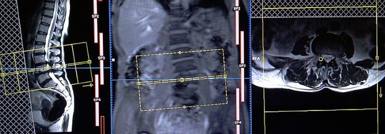lumbar spine MRI planning variations