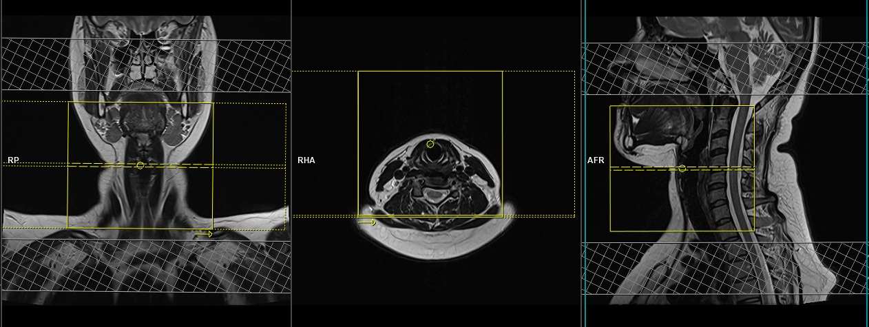 Larynx MRI Planning and Protocols | Indications for MRI Larynx
