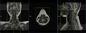 Larynx MRI Planning and Protocols | Indications for MRI Larynx