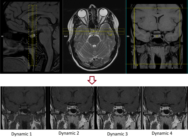Pituitary MRI Protocols, Planing and Indications | Pituitary Dynamic