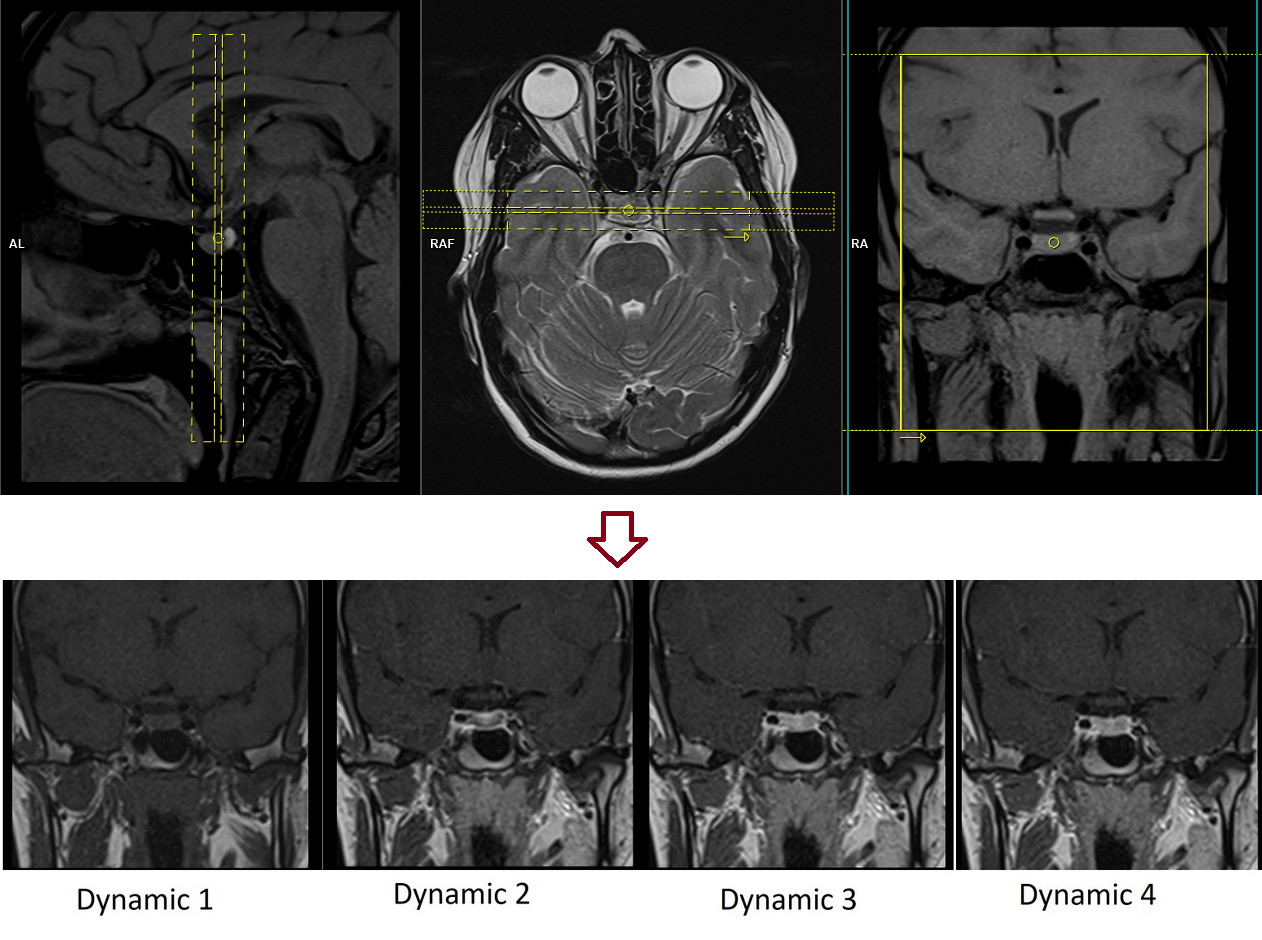 Pituitary MRI Protocols, Planing and Indications | Pituitary Dynamic