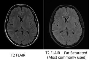 FLAIR MRI | FLAIR MRI Sequence Physics, Image and Pathology Appearance