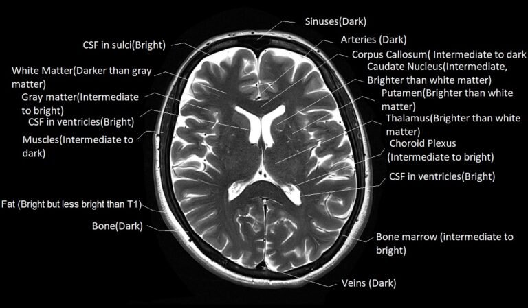 T1 Vs T2 Vs Pd Vs Flair Mri T1 Vs T2 Vs Pd Vs Flair Mri Image Comparison