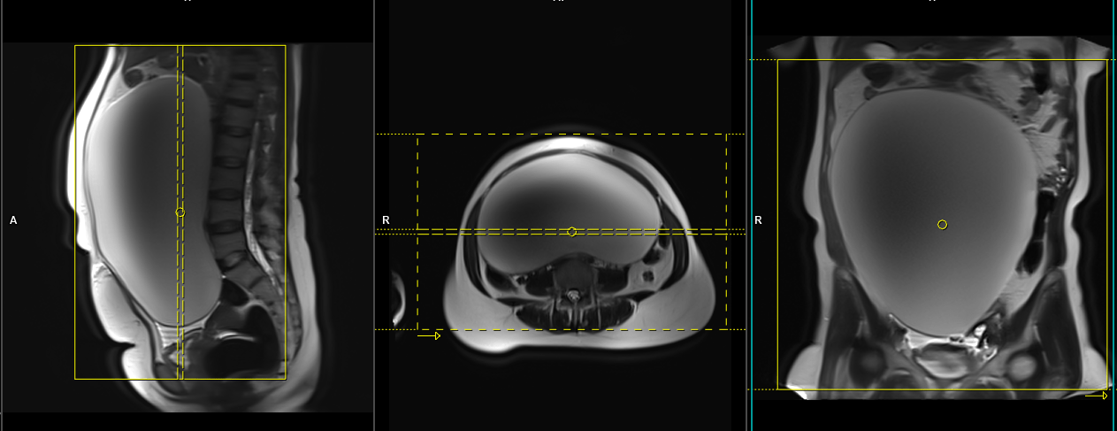 large pelvic mass mri | Abomen mass mri Protocol and Planning