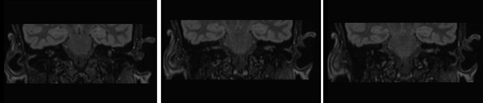 IAM's Ménière’s Disease | IAMS Ménière’s Disease Protocol and Planning