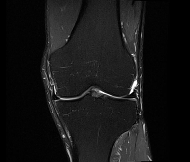 Proton Density (PD) Fat Saturation MRI Sequence Physics and Image ...