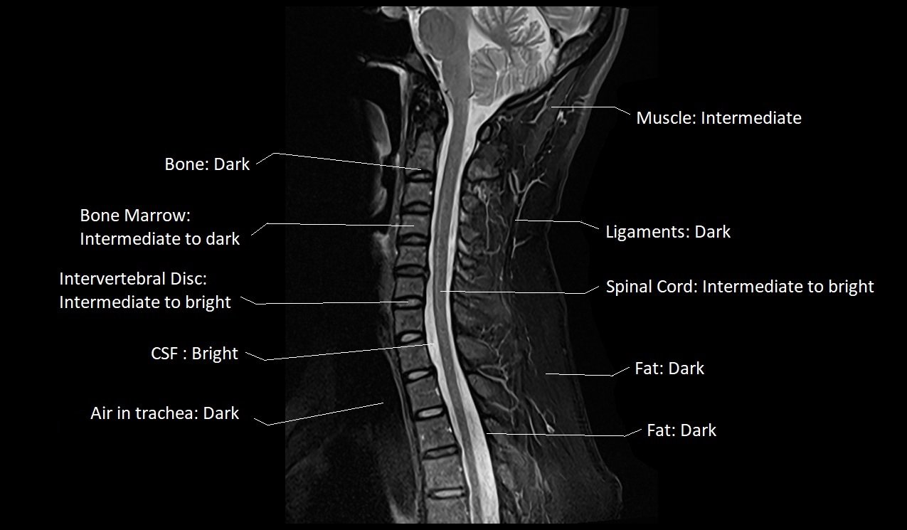 FLAIR vs STIR MRI | FLAIR vs STIR MRI image comparison