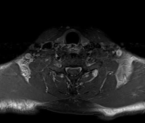 MRI Soft tissue neck axial T1 fat sat post contrast images