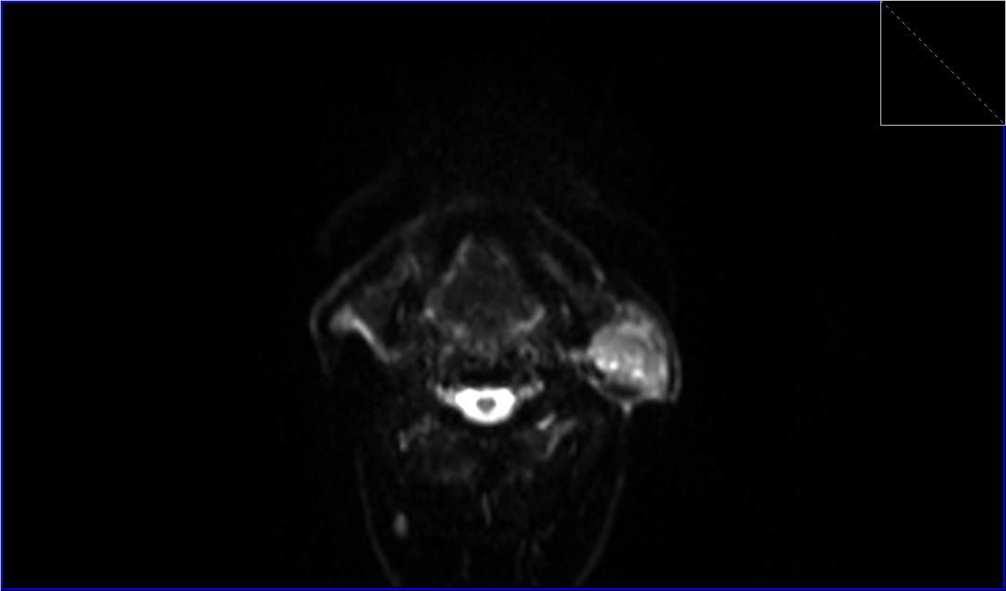 Warthin's tumor MRI