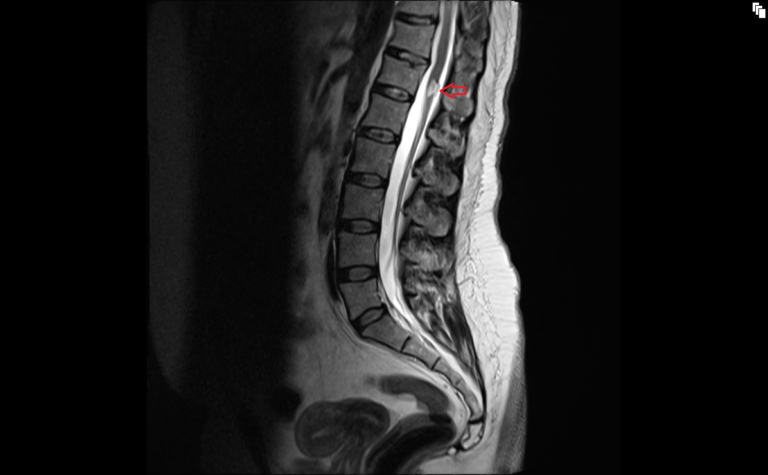 Lipoma of the conus medullaris MRI | Radiology article on spinal lipomas