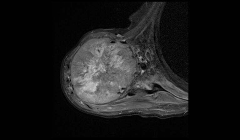 Shoulder metastasis MRI | Radiology Article on Shoulder metastasis