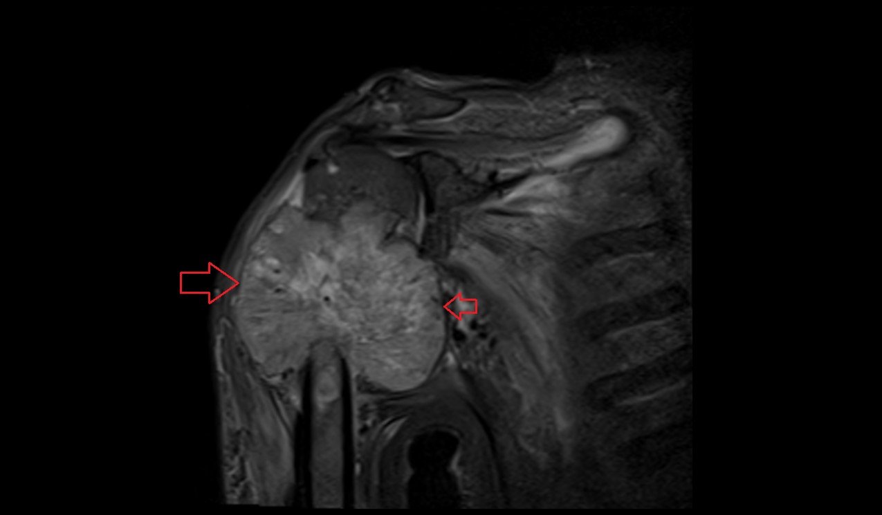 Shoulder metastasis MRI | Radiology Article on Shoulder metastasis