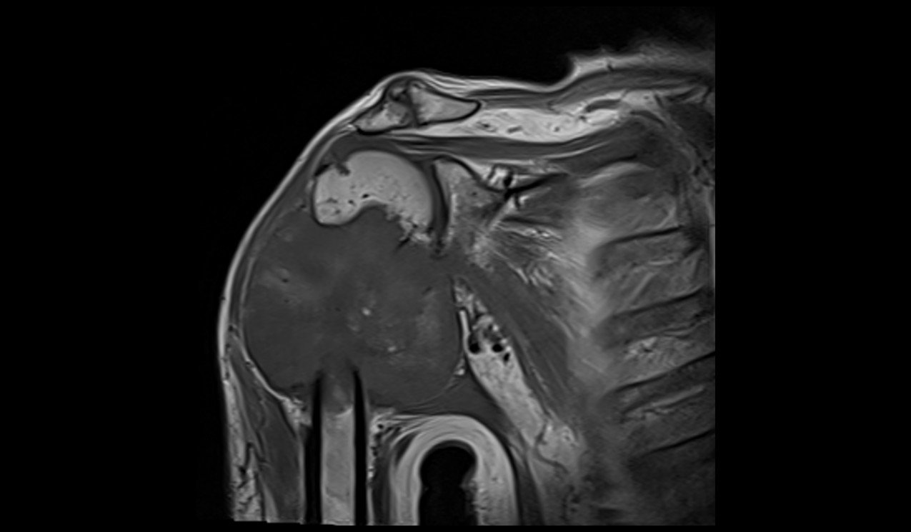 Shoulder metastasis MRI | Radiology Article on Shoulder metastasis