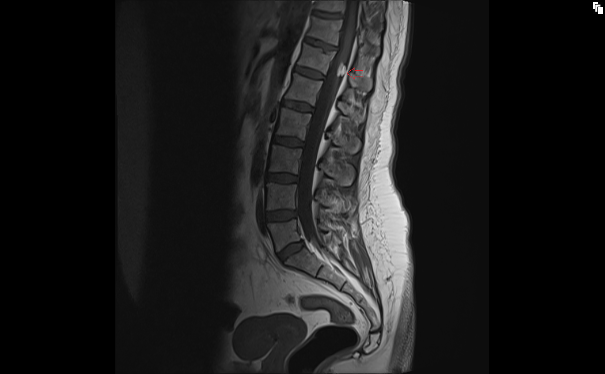 Lipoma of the conus medullaris MRI | Radiology article on spinal lipomas