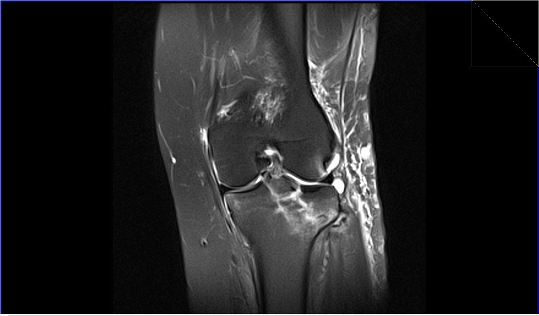 MRI Knee fractures | Radiology Article on Knee Fractures