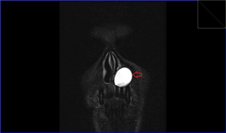 Epidermoid cyst MRI | Radiology Article on MRI of Epidermoid Cysts