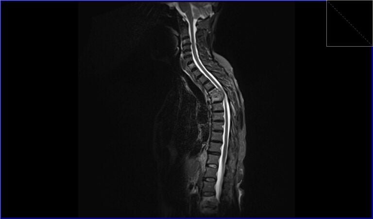 Metastatic spinal cord compression mri | Radiology article