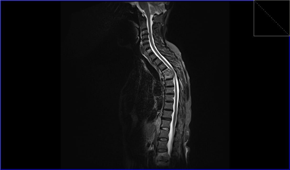 Metastatic spinal cord compression mri | Radiology article