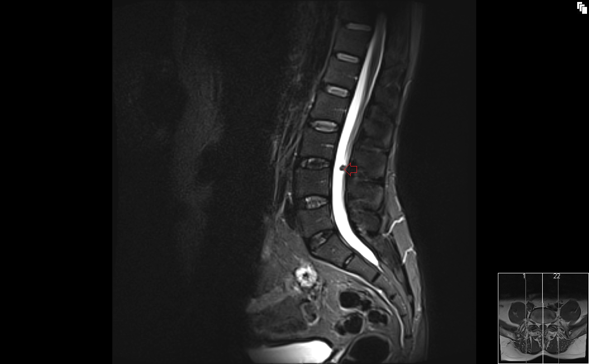 Neurofibroma MRI | Radiology article on neurofibroma
