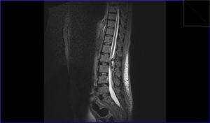 Spinal Seroma MRI | Radiology article on how to report Seroma