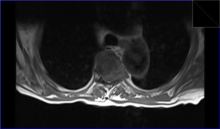 Metastatic spinal cord compression mri | Radiology article