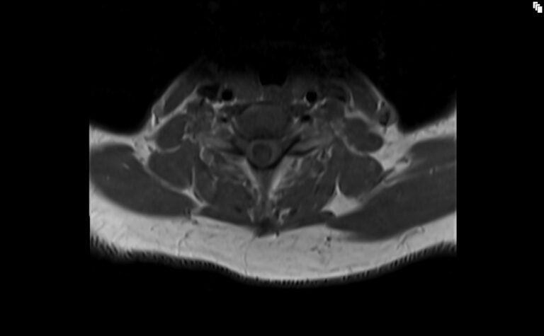 Syringomyelia MRI | Radiology article on syrinx