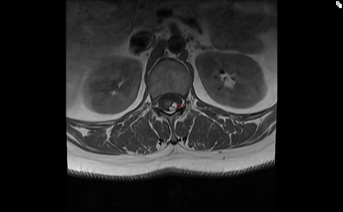 Lipoma of the conus medullaris MRI | Radiology article on spinal lipomas