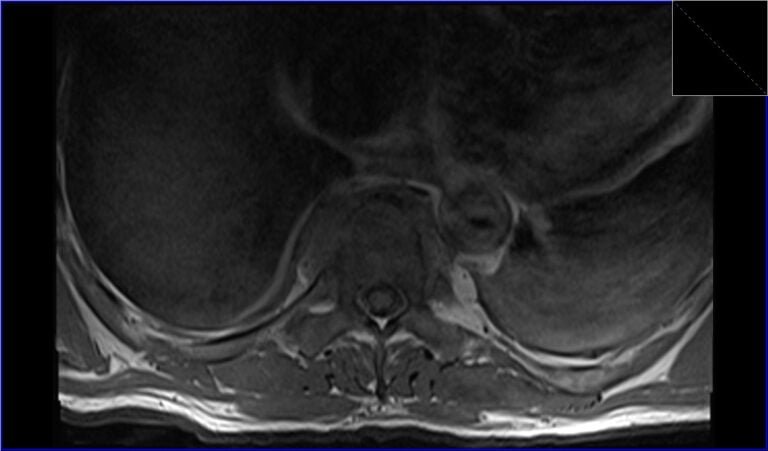 Discitis MRI | Radiology article on how to report Spondylodiscitis