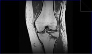 MRI Knee fractures | Radiology Article on Knee Fractures