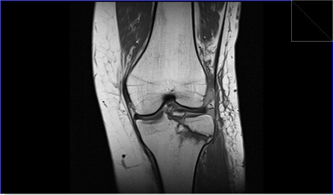 MRI Knee fractures | Radiology Article on Knee Fractures