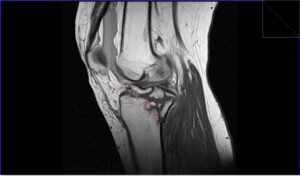 MRI Knee fractures | Radiology Article on Knee Fractures