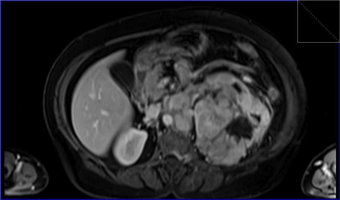 Renal cell carcinoma (RCC) MRI