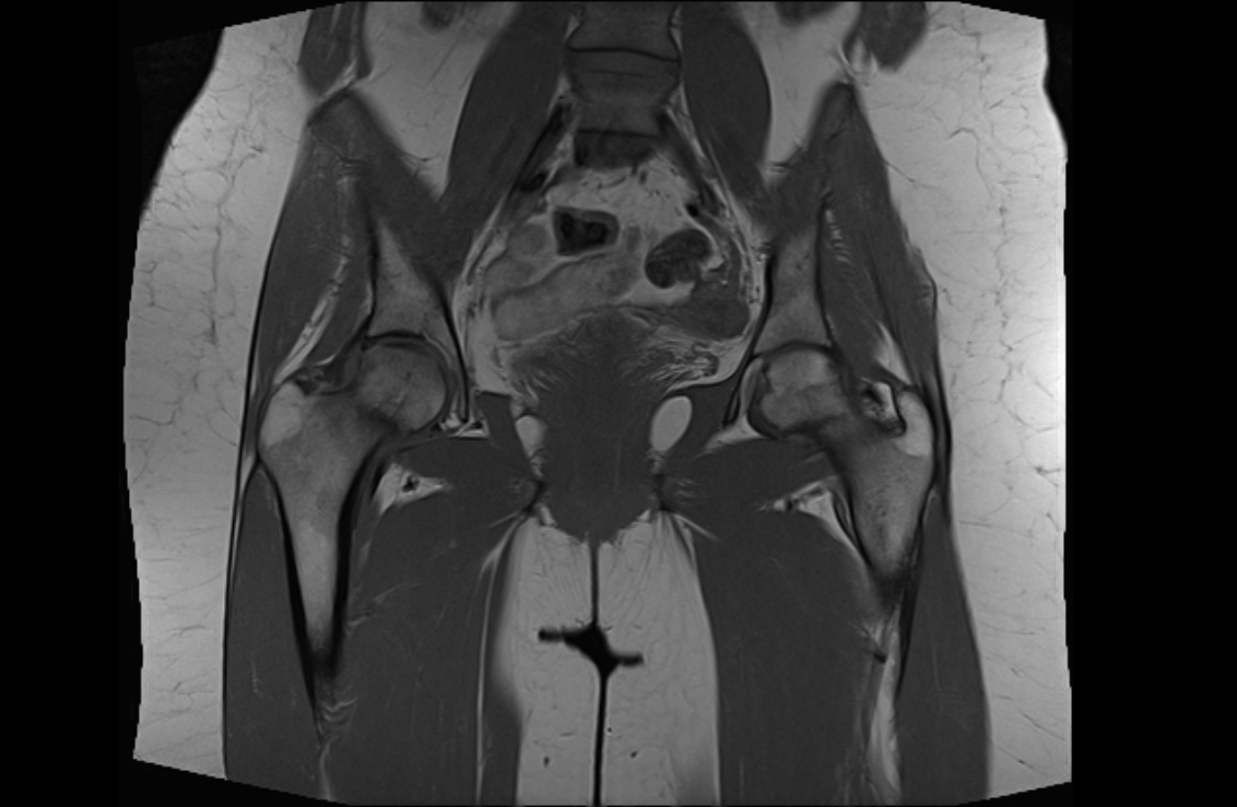 MRI Hip fractures | Radiology article on Hip fractures