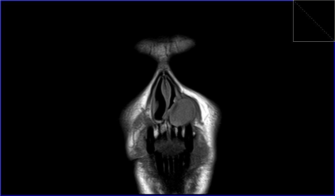 Epidermoid cyst MRI | Radiology Article on MRI of Epidermoid Cysts