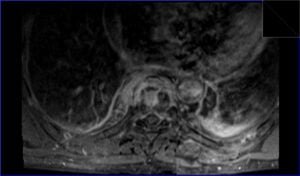Discitis MRI | Radiology article on how to report Spondylodiscitis